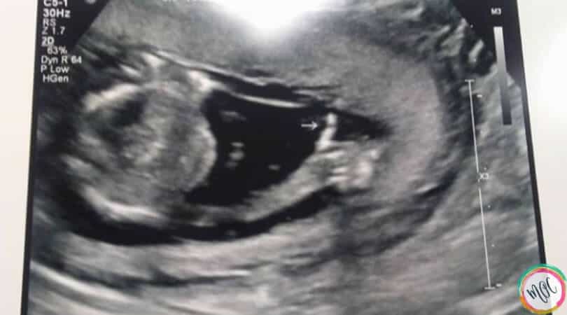 Acrania Termination for Medical Reasons - Mama's Organized Chaos